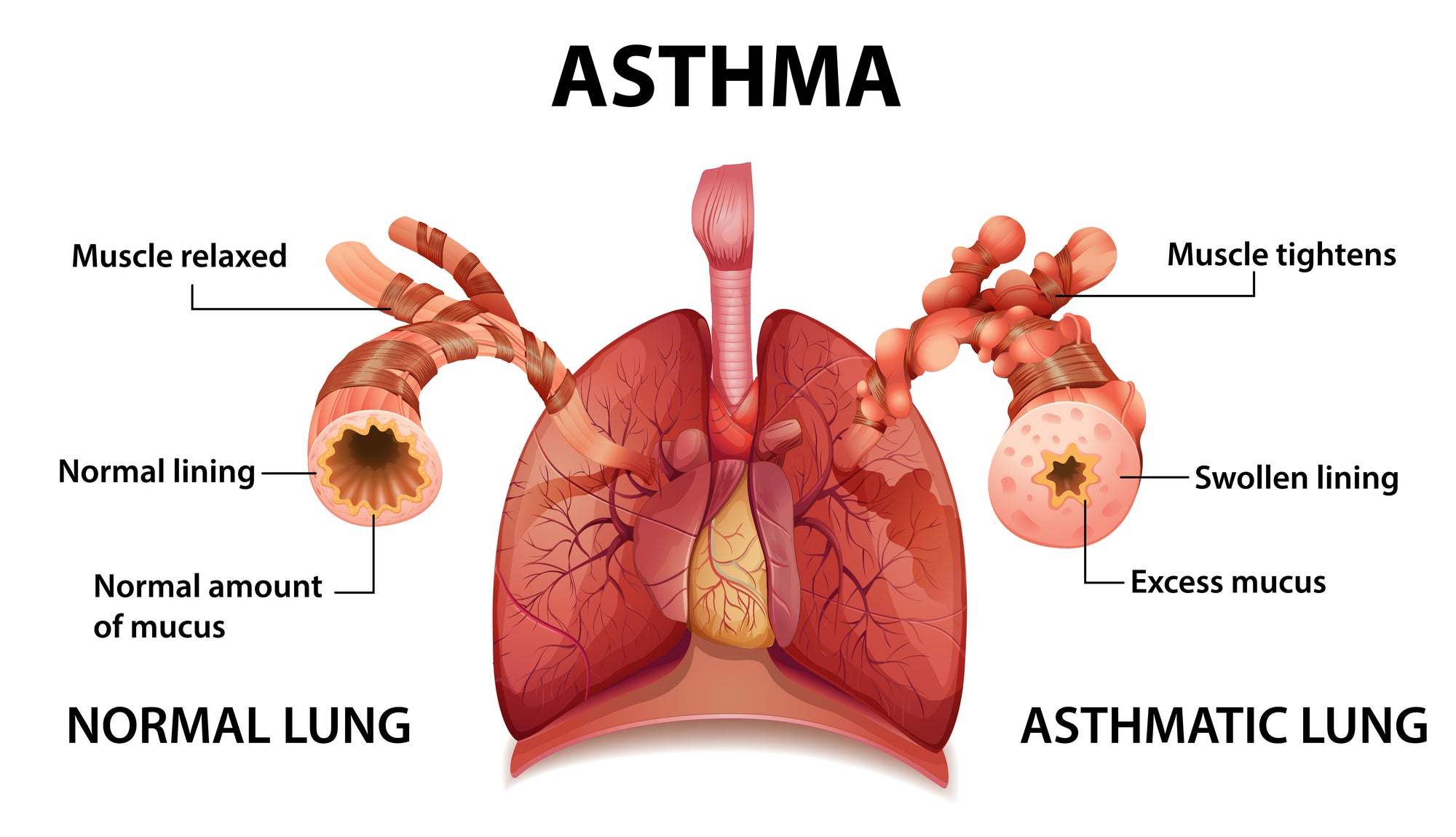 Asthma - New Research Points to Bacteria – Colloidsforlife